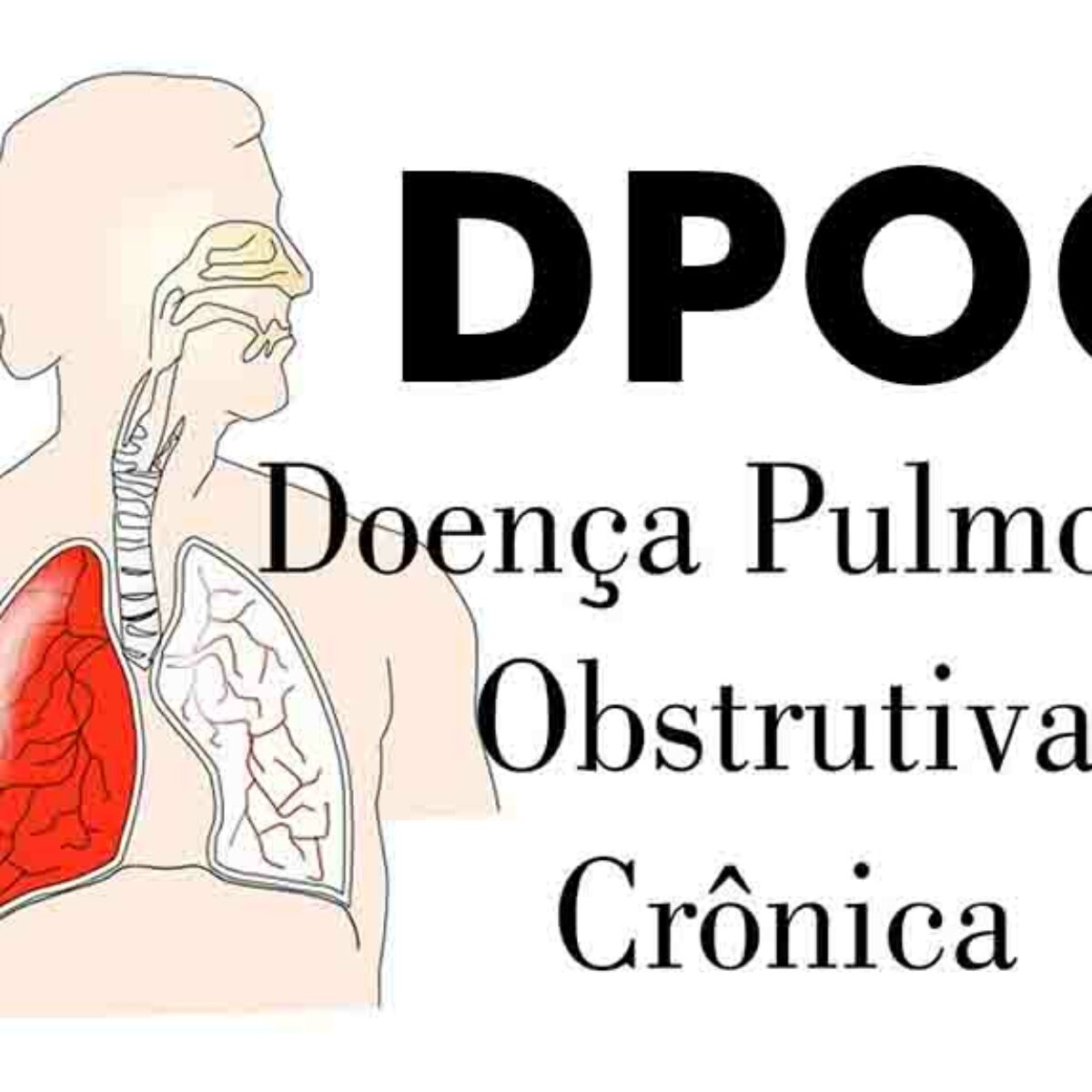 Doença Pulmonar Obstrutiva Crónica (DPOC)